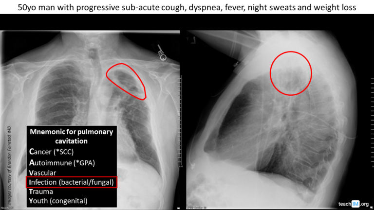 Cavitary Lesion Archives - teachIM