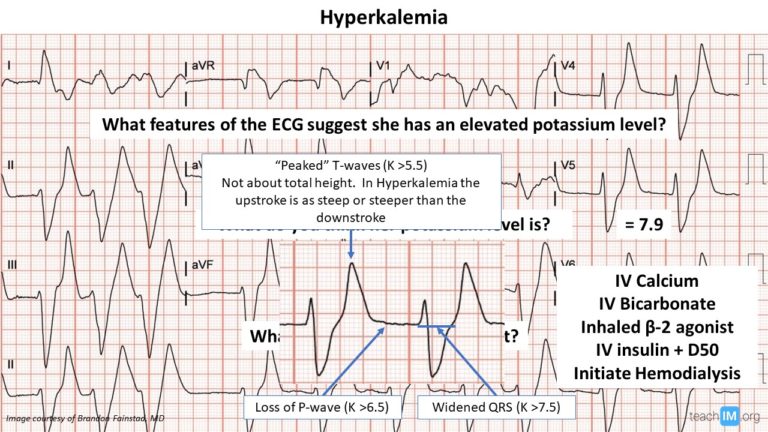 ECGs Archives - teachIM
