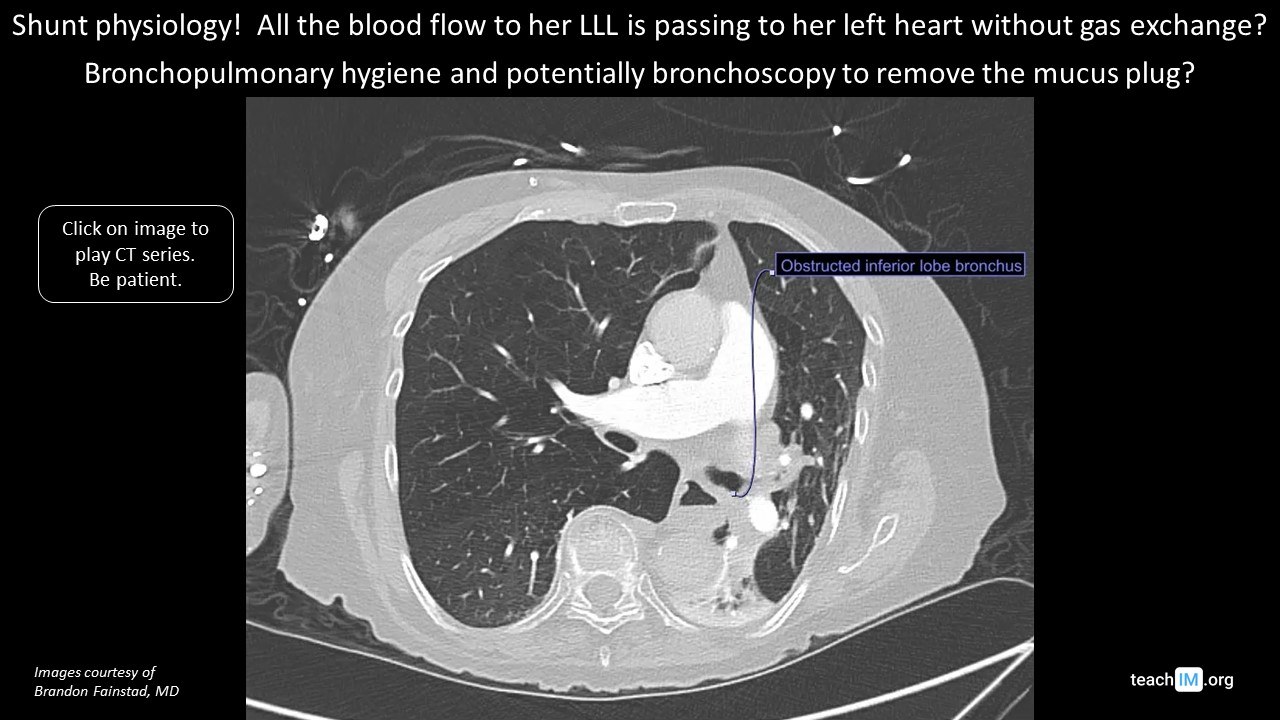 Atelectasis - Left Lobar Collapse - teachIM