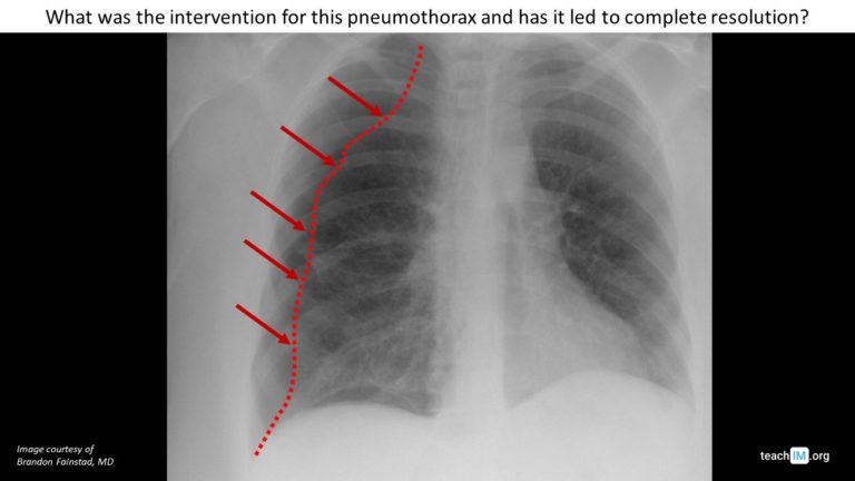 Chest X Ray Archives Teachim