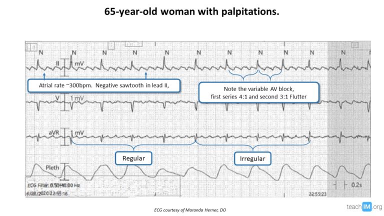 ECGs Archives - teachIM