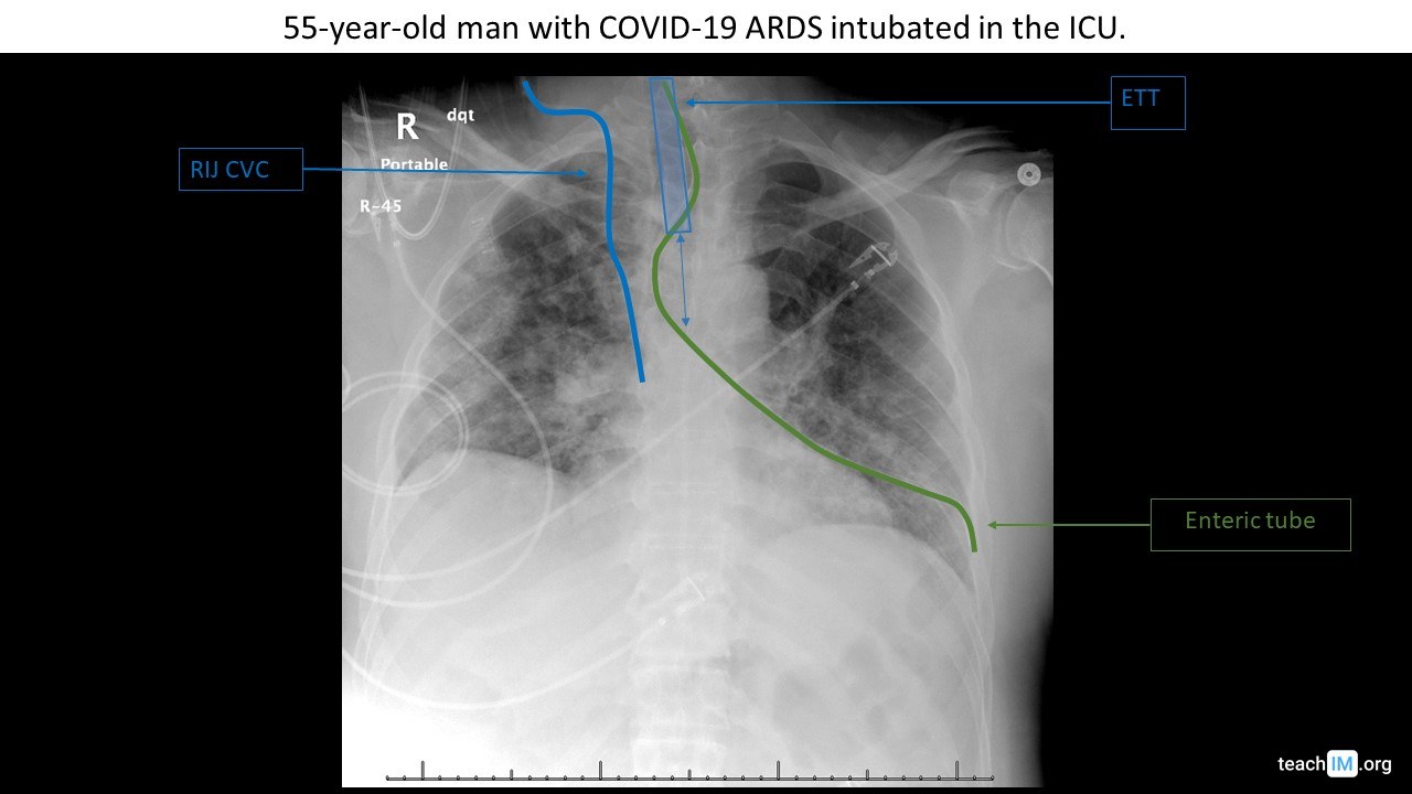 Gastric Tube Placement Cxr