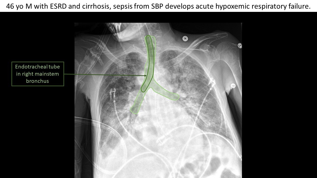 Right Mainstem Intubation Cxr Teachim