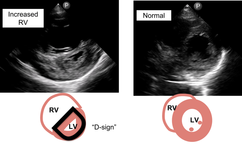 Cardiac Ultrasound Case Conference | POCUS | TeachIM