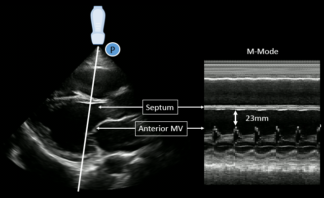 Cardiac Ultrasound Case Conference | POCUS | TeachIM